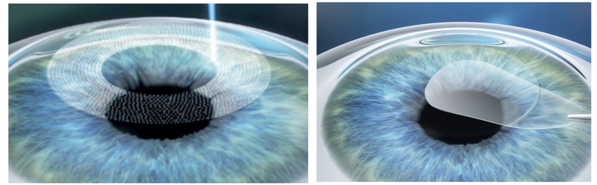 La chirurgie cornéenne - Chirurgie Ophtalmologie Paris | Dr Blumen Ohana