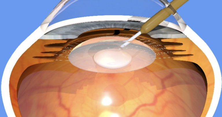 La chirurgie du cristallin - Chirurgie Ophtalmologie Paris | Dr Blumen ...