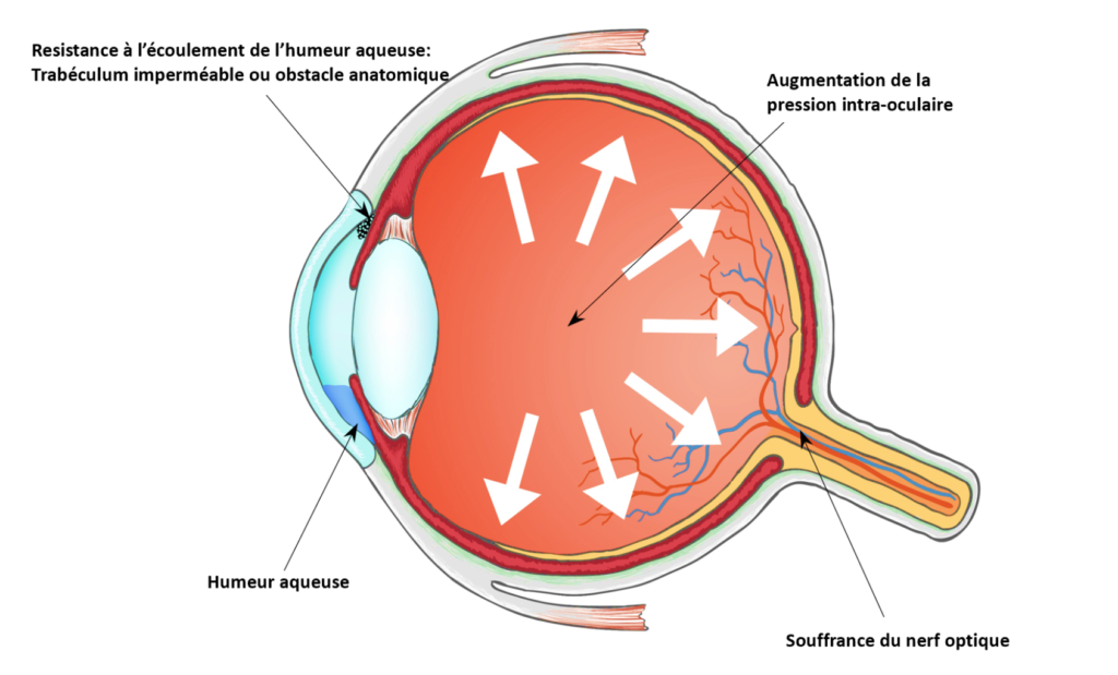 Le glaucome - Chirurgie Ophtalmologie Paris | Dr Blumen Ohana