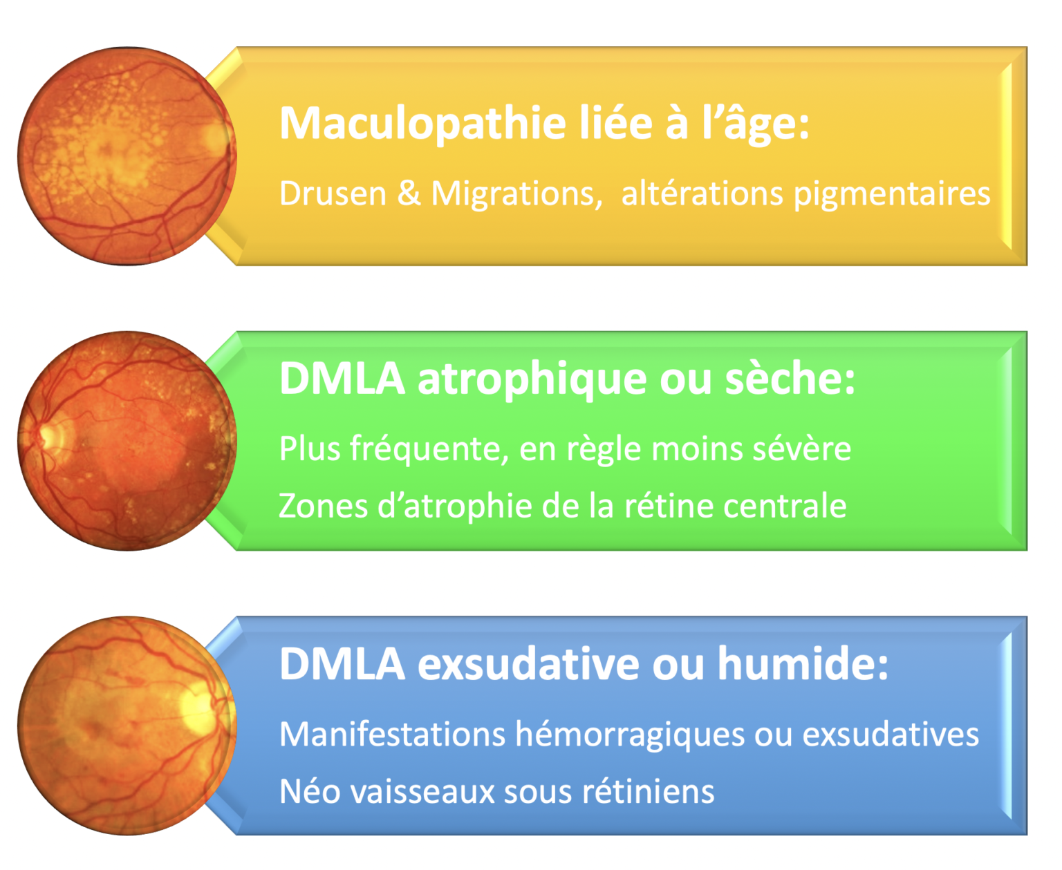 La DMLA, dégénérescence maculaire liée à l’âge - Chirurgie ...