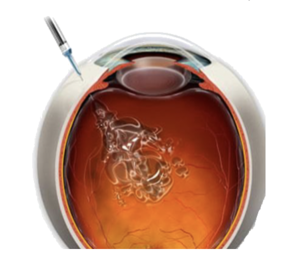 La DMLA, dégénérescence maculaire liée à l’âge - Chirurgie ...