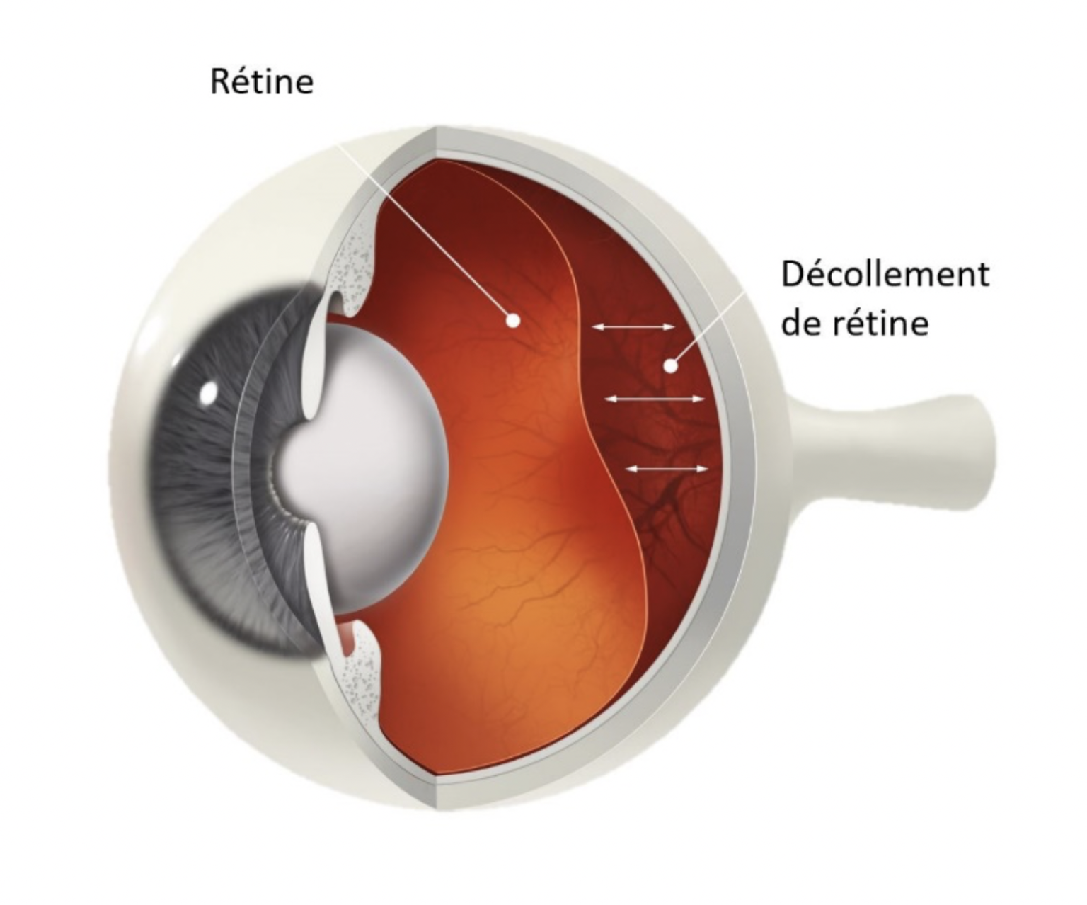 Le décollement de rétine - Chirurgie Ophtalmologie Paris | Dr Blumen Ohana
