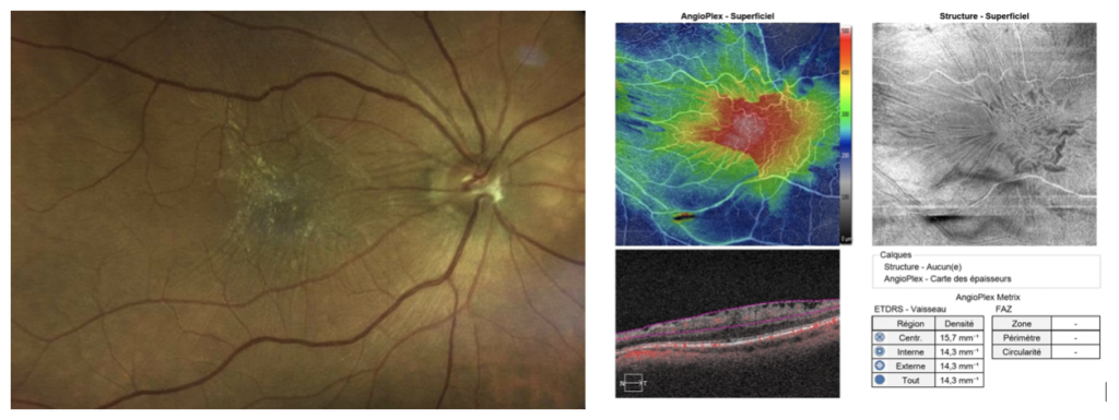 Membrane épi-rétinienne & membrane épi-maculaire - Chirurgie ...