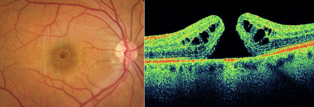 Trou maculaire - Chirurgie Ophtalmologie Paris | Dr Blumen Ohana Paris