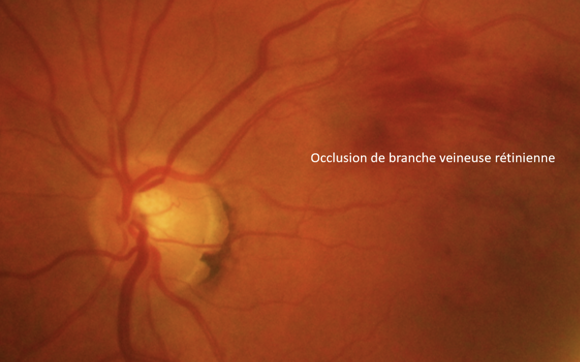 Les occlusions veineuses rétiniennes - Chirurgie Ophtalmologie Paris ...